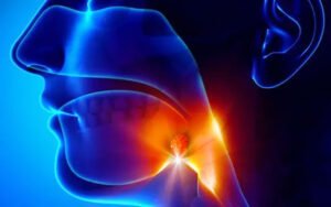 Understanding Adenoiditis: Causes, Symptoms, And Analysis Options ...